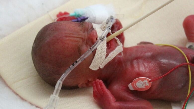 “世界最小の赤ちゃん”成長の記録 母「元気で幸せ」 出生時は258g 6歳になり来年は小学生 将来の夢は「警察官」｜FNNプライムオンライン