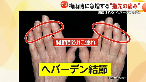 【なぜ？】梅雨時に急増する“指先の痛み” 関節腫れる「へバーデン結節」…国内で約300万人 “スマホの触りすぎ”にも注意｜FNNプライムオンライン