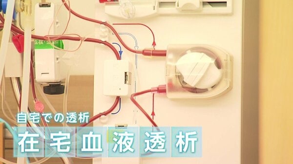全国普及率1％未満 自宅での人工透析「在宅血液透析」患者の負担軽減や仕事との両立などメリットも課題は病院の負担｜FNNプライムオンライン