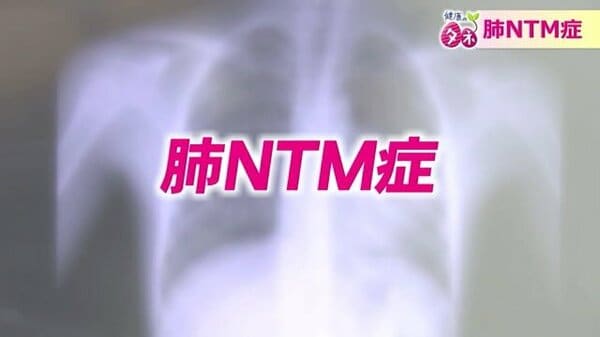 トリプルデミックに加え「肺NTM症」が増加 土壌や水回り…日常に潜む感染リスク 咳やたんが3週間続いたら受診を ｜FNNプライムオンライン